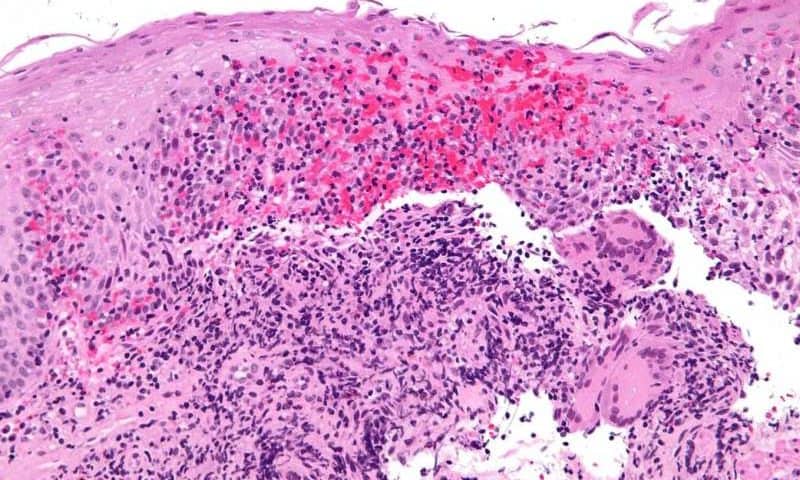 Genetic mutation linked to iron deficiency in Crohn’s disease patients ...